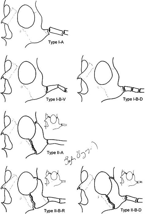 A New Proposal Of Classification Of Zygomatic Arch Fractures Journal