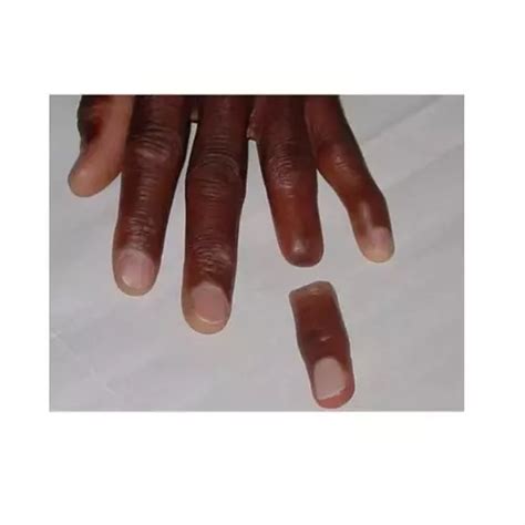 Passive Prosthetic Silicone Artificial Finger At Best Price