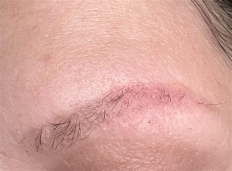 No Eyebrows And “rash” Rdermatologyquestions