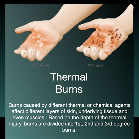 Thermal Injuries