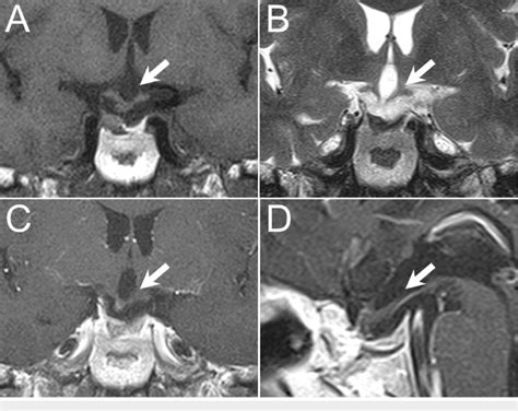 Post Operative Magnetic Resonance Imaging Mri Post Operative Mri