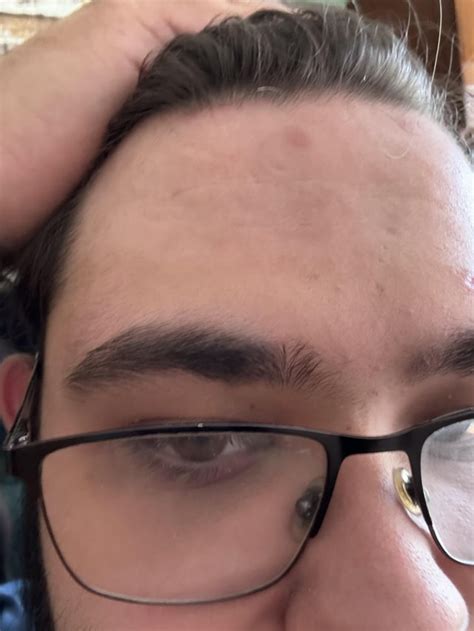 Psoriasis On Forehead R Psoriasis