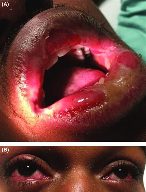 A Mucositis And Erythematous Lips Erosions B Bilateral