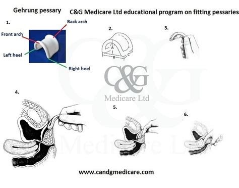 Gehrung Pessary Suitable For Cystocele Rectocele And Procidentia