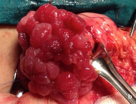 Multiple Gastric Polyps Protruding To The Duodenum Download Scientific Diagram