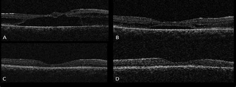 Optic Disk Pit Stuffing—to Do Or Not To Do Retinal Cases And Brief Reports