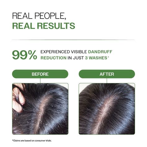 Anti Dandruff Shampoo For Dandruff And Itchy Scalp Bare Anatomy Innovist
