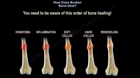 Fracture Healing How Bones Heal Types Stages And Key Factors Youtube