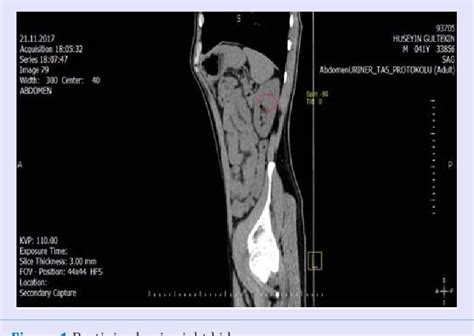 Figure 3 From Hypertrophied Column Of Bertin And Double Collecting