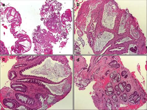 Histopathological Findings A Prominent Polypoid Lesions Seen At Low