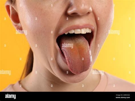 Gastrointestinal Diseases Woman Showing Her Yellow Tongue On Color Background Closeup Stock