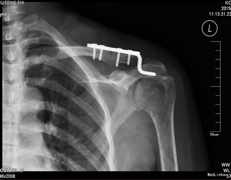 中西医结合治疗锁骨骨折 医联