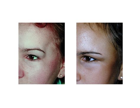 Temporal Implant Augmentation Dr Barry Eppley Indianapolis Explore Plastic Surgery