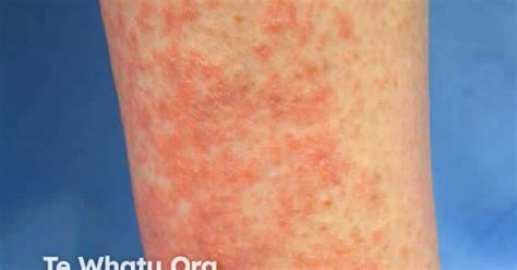 Pemphigoid Gestationis 00012 Image