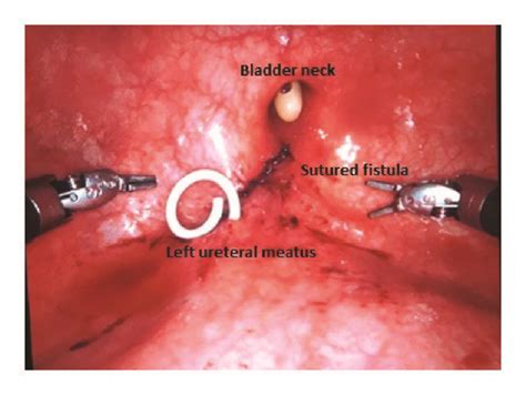 Final Appearance Of The Treated Fistula After Suture Of Bladder