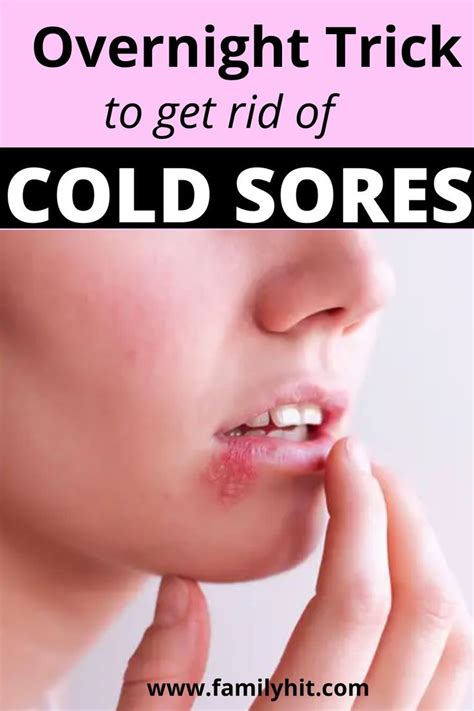 Cold Sore On Face Cover Up Cold Sore Cold Sore Scab Natural Cold