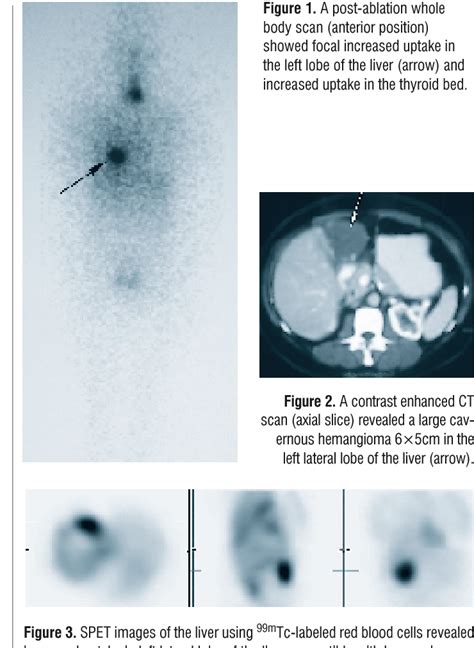 Figure 3 From Uptake Of 131i On A Post Thyroid Ablation Whole Body