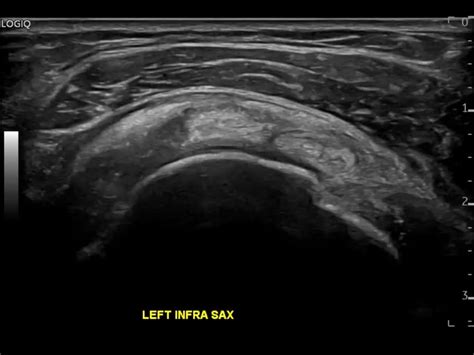 Msk Australia On Linkedin Rotator Cuff Tendon Tear Supra Infra