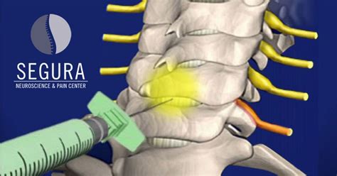 Lumbar Epidural Steroid Injections Side Effects At Brianna Gellatly Blog