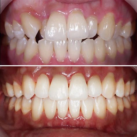 Orthodontic Before And After Results By Pro Dental Clinic