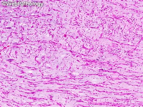 Cardiac Myxoma Microscopic Features