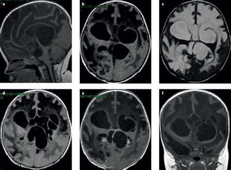 11 Multiloculated And Complex Hydrocephalus Neupsy Key
