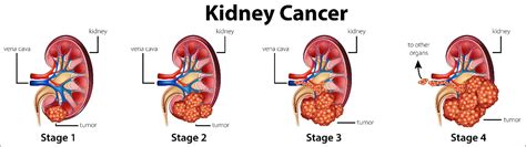 Renal Cell Carcinoma Causes Symptoms Diagnosis Treatment