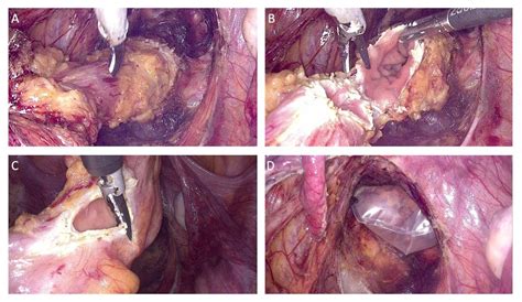 Total Laparoscopic Segmental Resection With Transanal Nose For Deep Colorectal Endometriosis