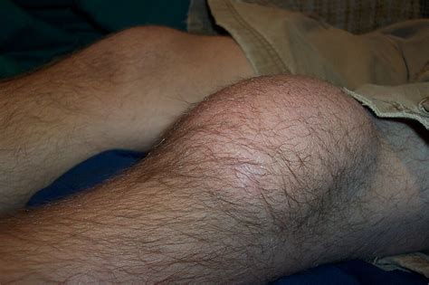 Prepatellar Bursitis Wikiwand