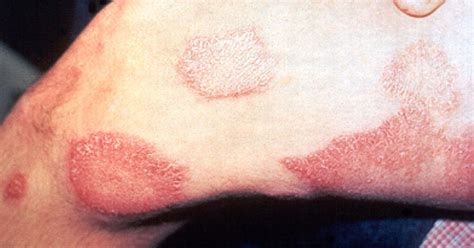 This Strange Disease Is Making A Comeback Officials Say You Need To