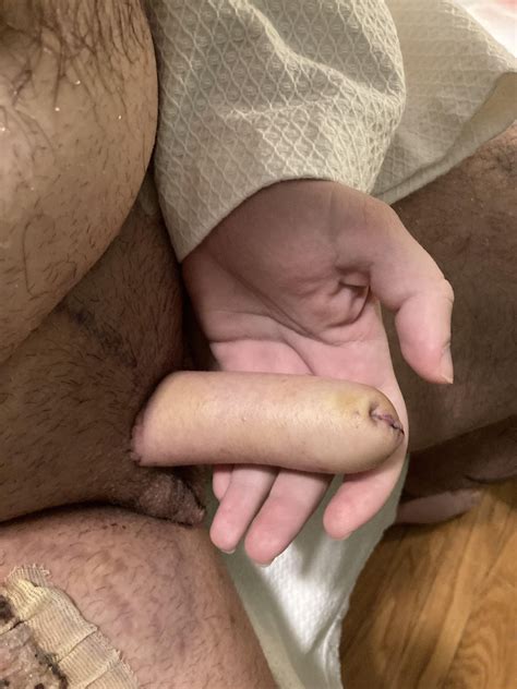 6 Days Post Op Phallo And Scroto No Ul No V Ectomy Rphallo
