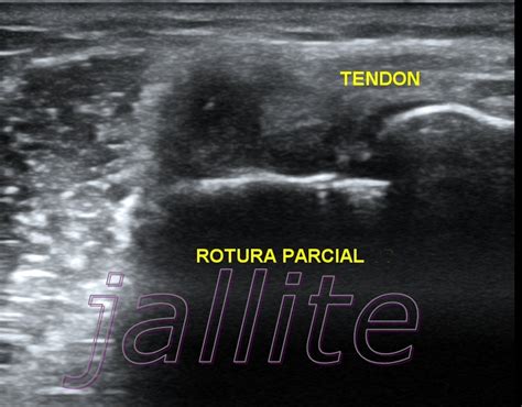 Rotura Tendón Extensor Común Codo