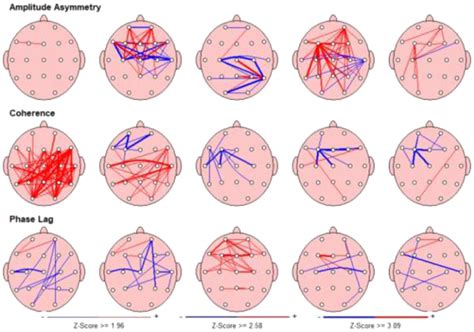 An Example Of Qeeg Summary Maps In The Adhd Rd Group Hypocoherence Download Scientific