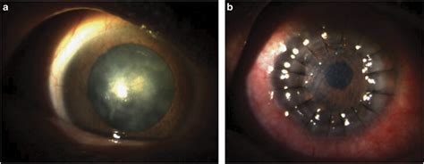 Pre Operative Photo Showing The Dense Corneal Scarring In An Eye With