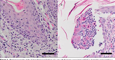 Figure 2 From Comorbidity Of Ectopic Thymoma Associated Exfoliative