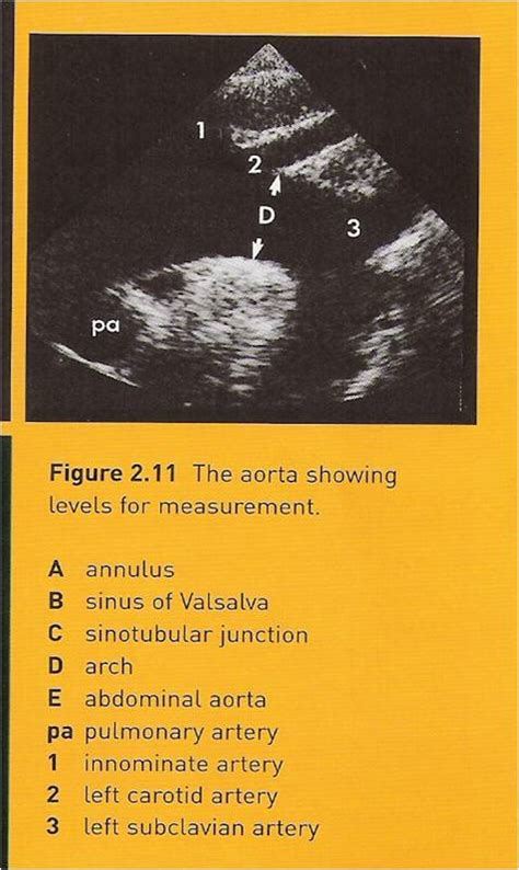 Cvt Mohd Farid Basic Echo Window Suprasternal View