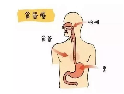 科普 了解食管癌 健康教育 漯河市中心医院