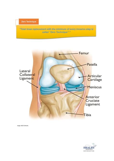 Zero Technique Revolutionizing Total Knee Replacement Tkr Pdf