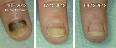 Green Nail Syndrome Pseudomonas Aeruginosa Nail Infection Two Cases