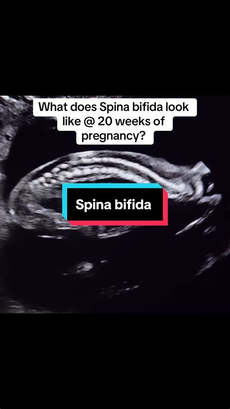 Understanding Spina Bifida 20 Week Ultrasound Scan Revealed Tiktok