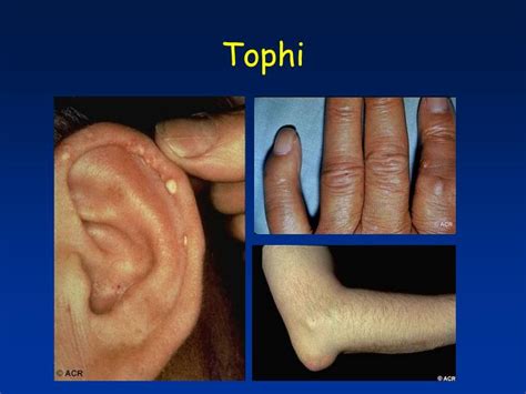 Ppt Crystal Induced Arthritis And Osteoarthritis Powerpoint