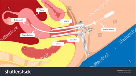Endometrial Biopsy