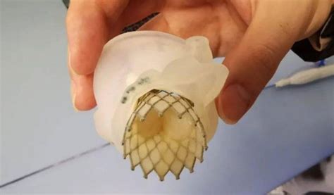 Valve Stent Basics Applications And Advancements Be