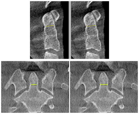 Odontoid Process Fracture