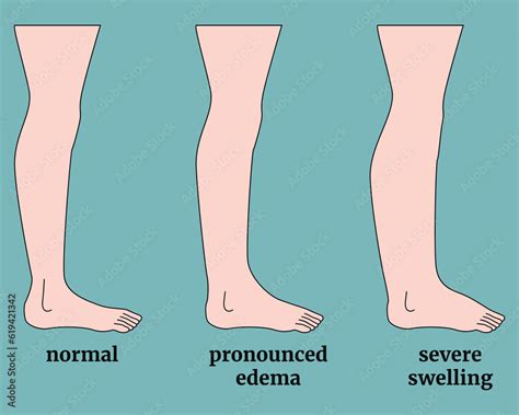 Stages Of Human Leg Edema Medical Background Or Poster Vector Flat