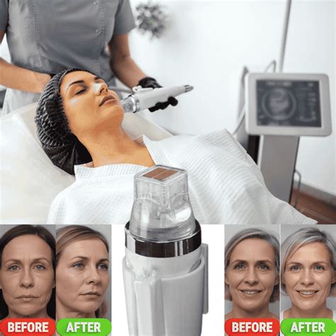 Rf Microneedling Before And After See The Incredible Results In 2025