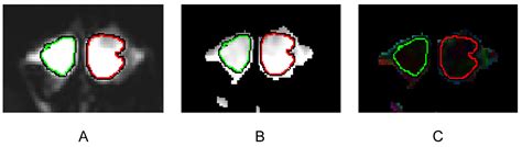 noninvasive prediction of sperm retrieval using diffusion tensor