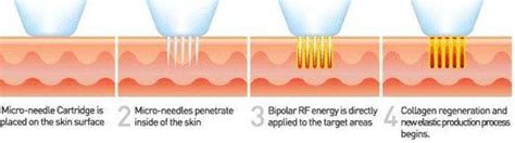 Fractional Rf Micro Needling Frm Beauty Machine Supplier