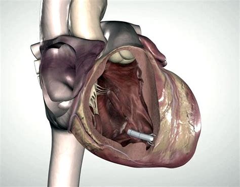 Medtronic Developing New Mini Pacemaker Mpr News