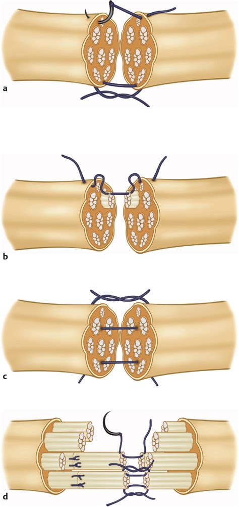 Techniques Of Nerve Repair Plastic Surgery Key